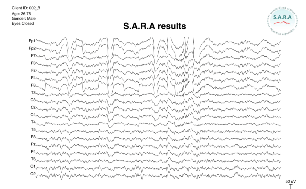 Download Sample Report – qEEG Pro